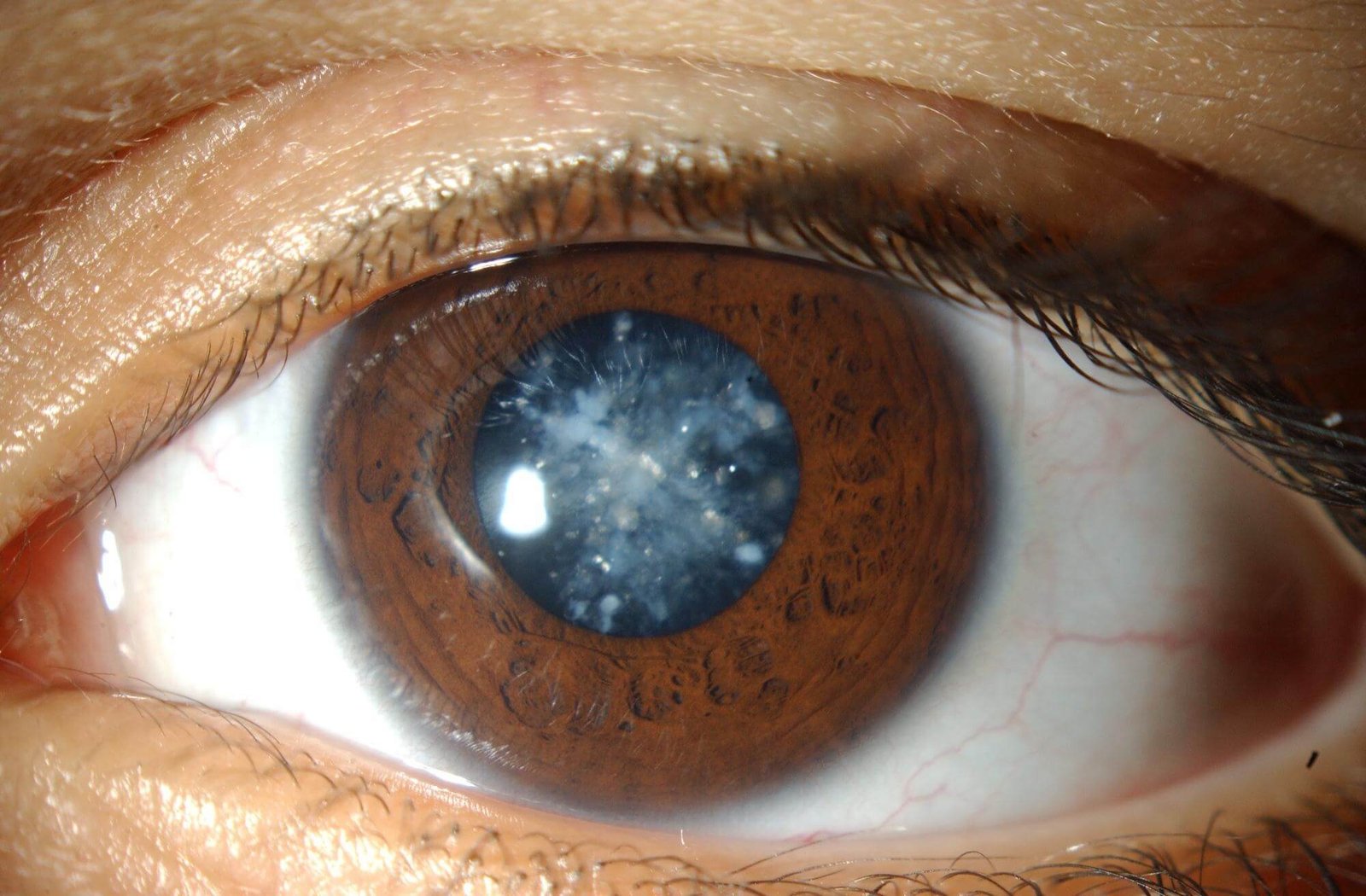 Can Cataracts Cause Blindness Delhieyecenter Can Cataracts Cause Blindness Delhieyecenter